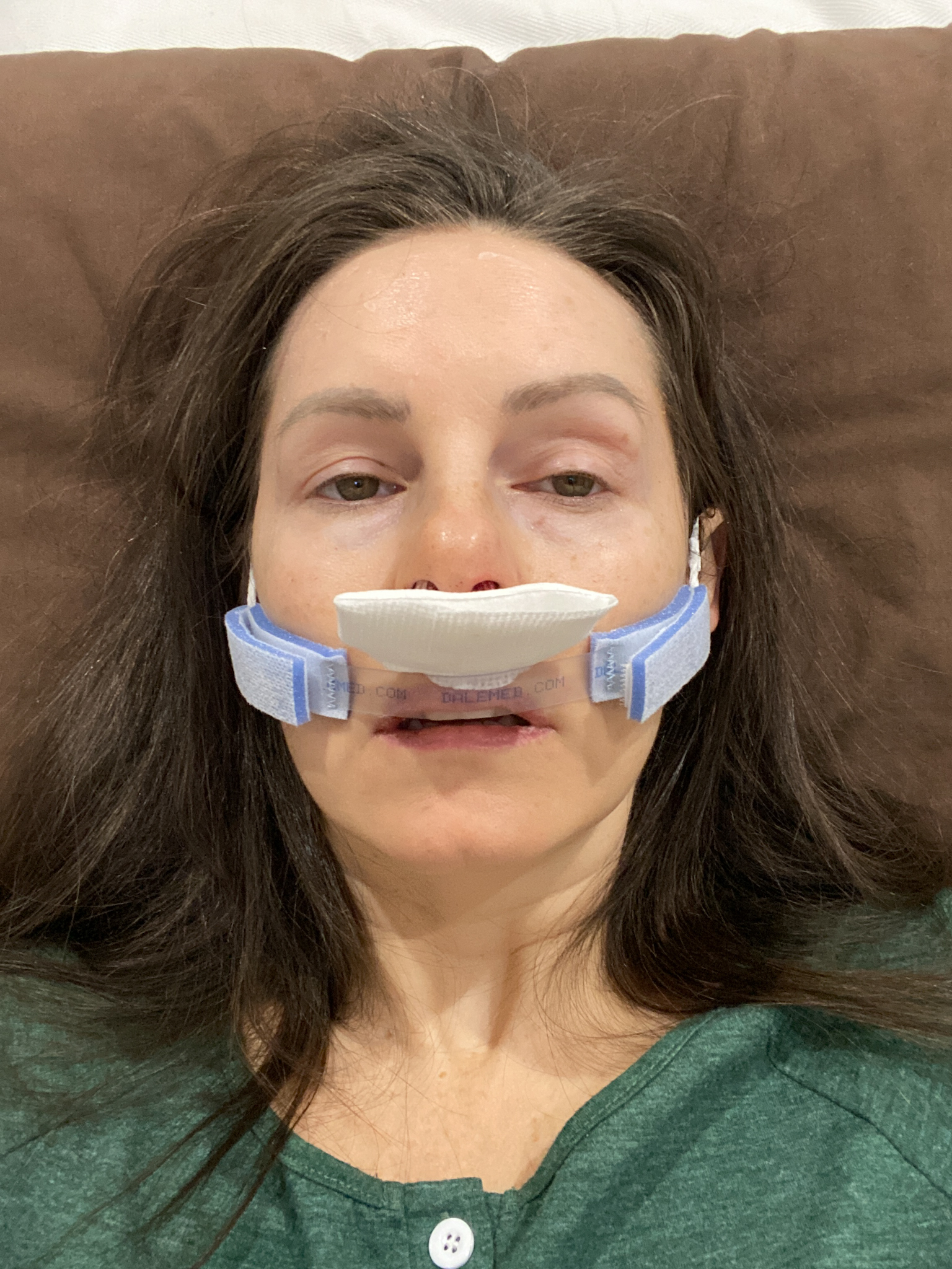 What is it like to have a Septoplasty? – The Maternal Hobbyist